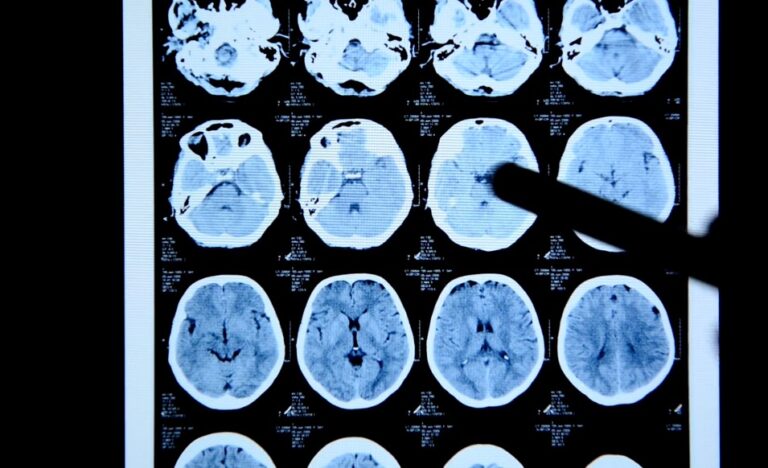 Will a CAT scan identify if I have had a Concussion?